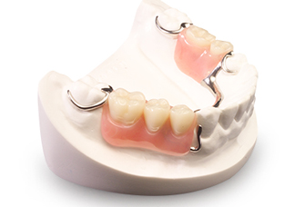 Cast-Metal – Pacific Rim Dental Laboratory